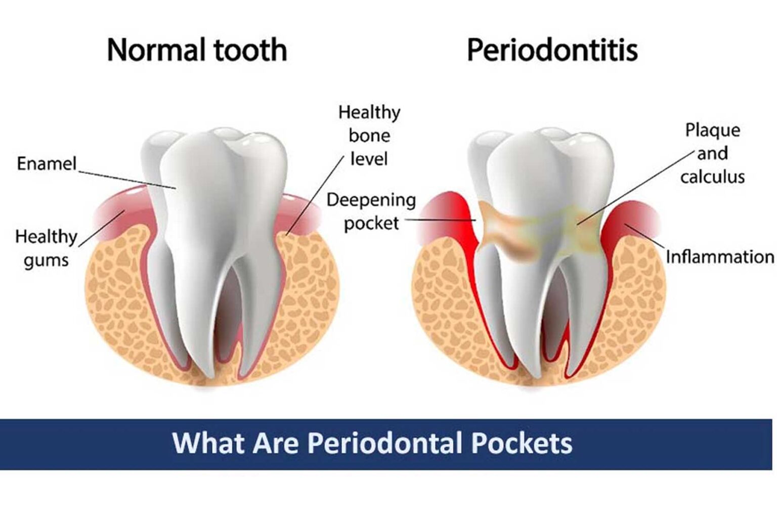 Periodontal Pockets: What They Are and How to Treat Them - Unity Square ...