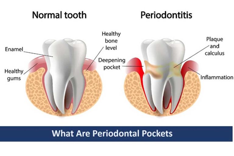 Periodontal Pockets: What They Are and How to Treat Them - Unity Square Dental